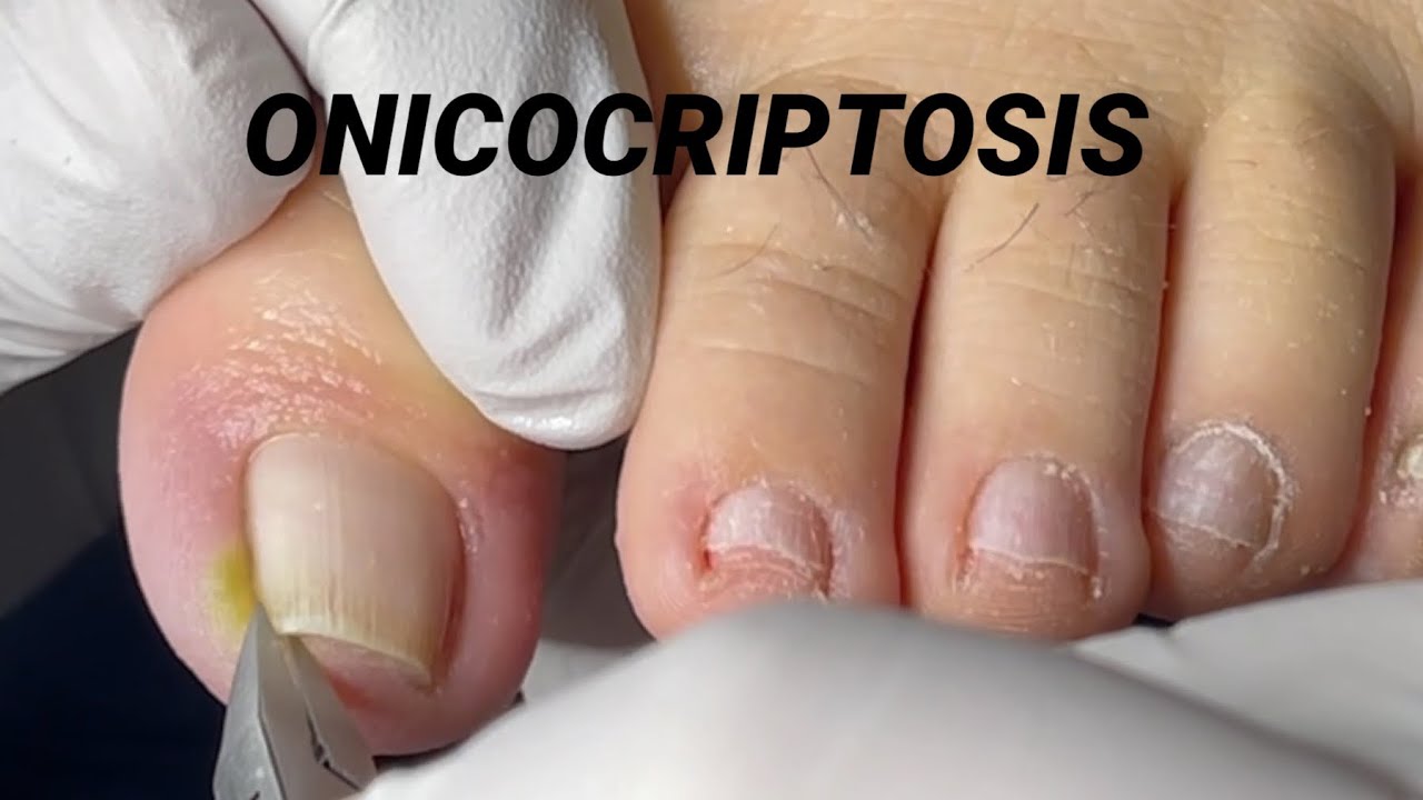 ONICOCRIPTOSIS EXTRACCIÓN - YouTube
