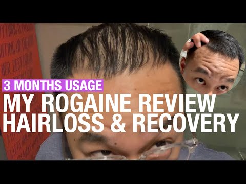 MY ROGAINE REVIEW: SERIOUS SHEDDING, HAIR LOSS & RECOVERY, 3 MONTHS USE