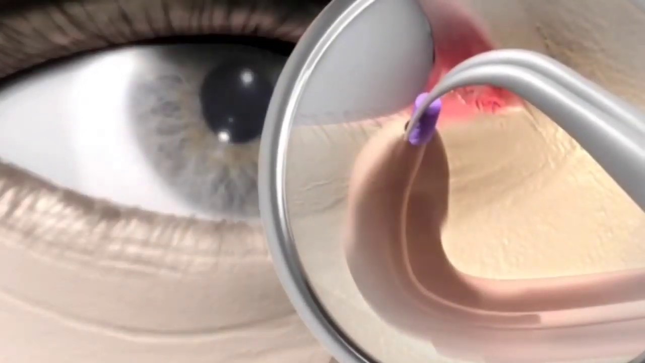 Punctum Plug Procedure Animation YouTube punctum-plug-procedure-animation-youtube