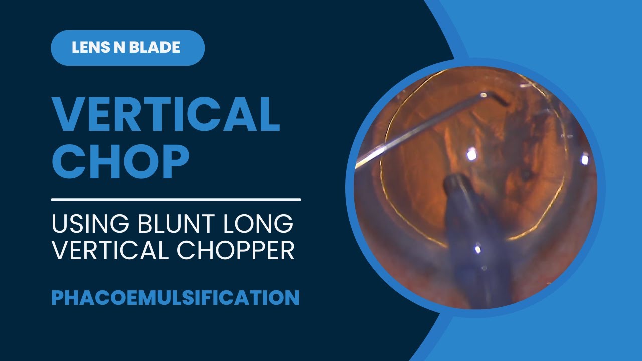 Phacoemulsification- Trying out new vertical chopper - YouTube