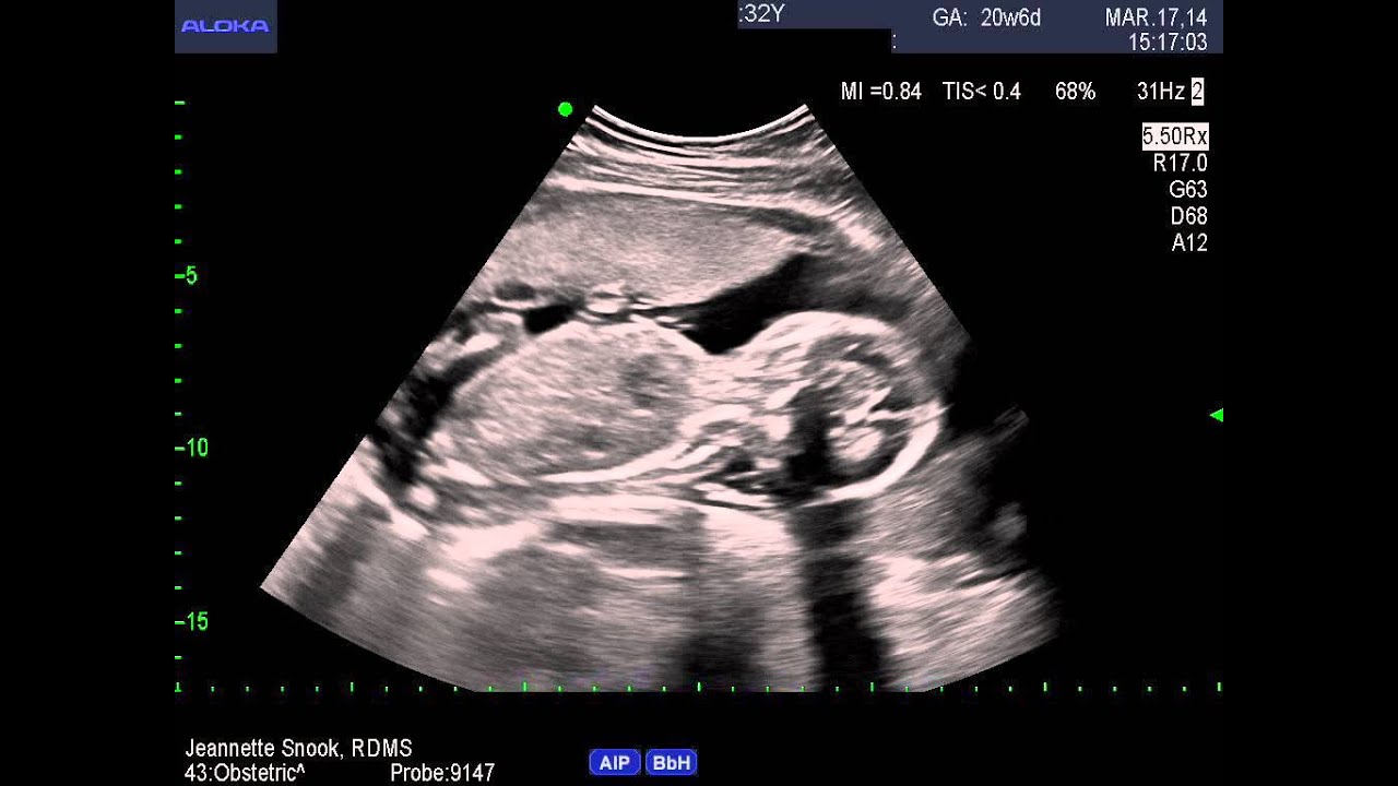 baby deen heartbeat 20 weeks - YouTube