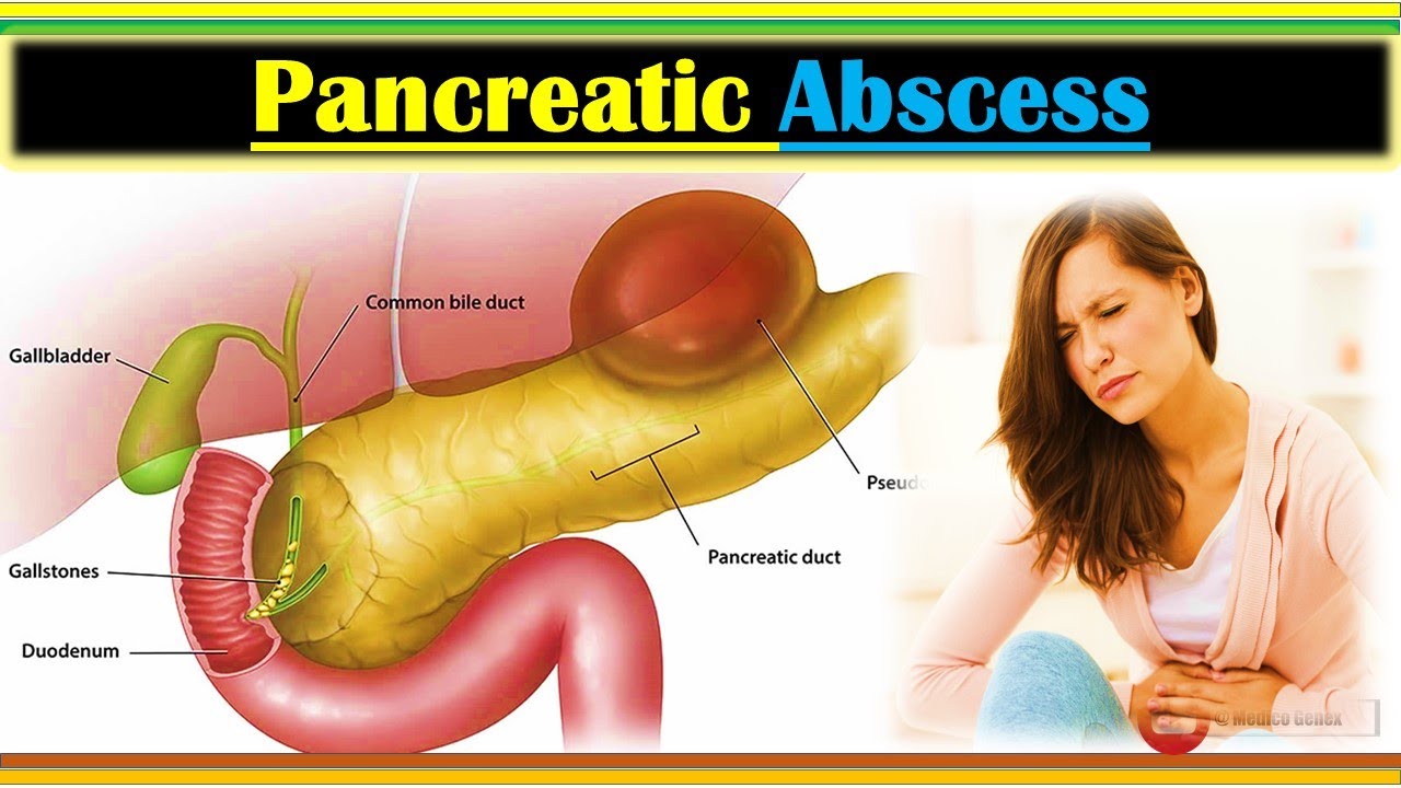 PANCREATIC ABSCESS | CAUSES | SIGN AND SYMPTOMS | TREATMENT OF ...