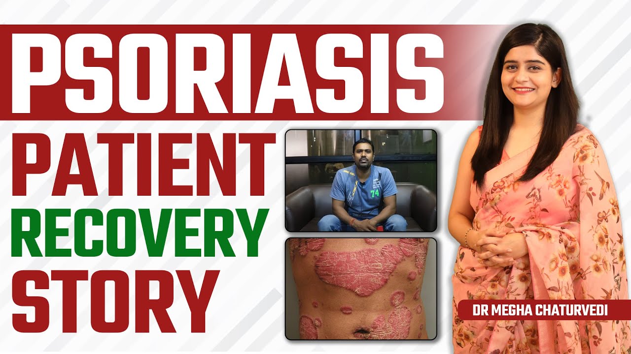 Psoriasis Patient Recovery Story By Dr Megha Chaturvedi | Ayurvedic ...