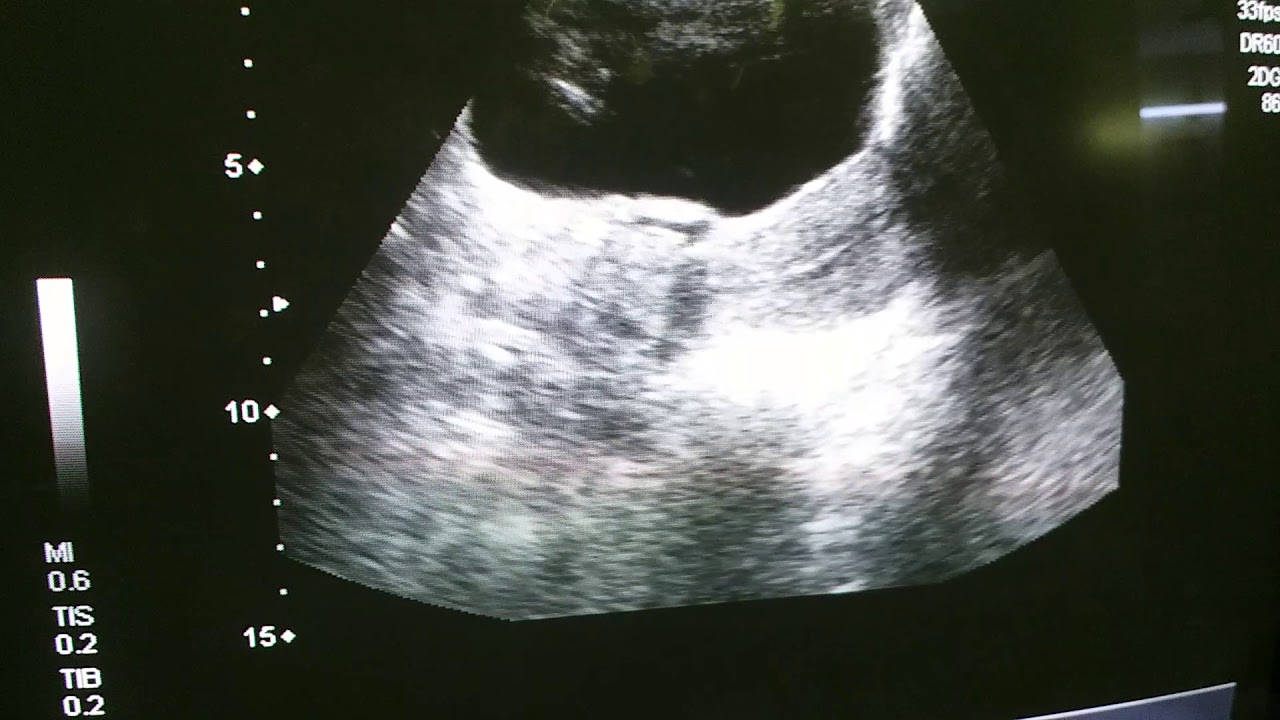 Menstrual Cup : Ultrasound Picture - YouTube