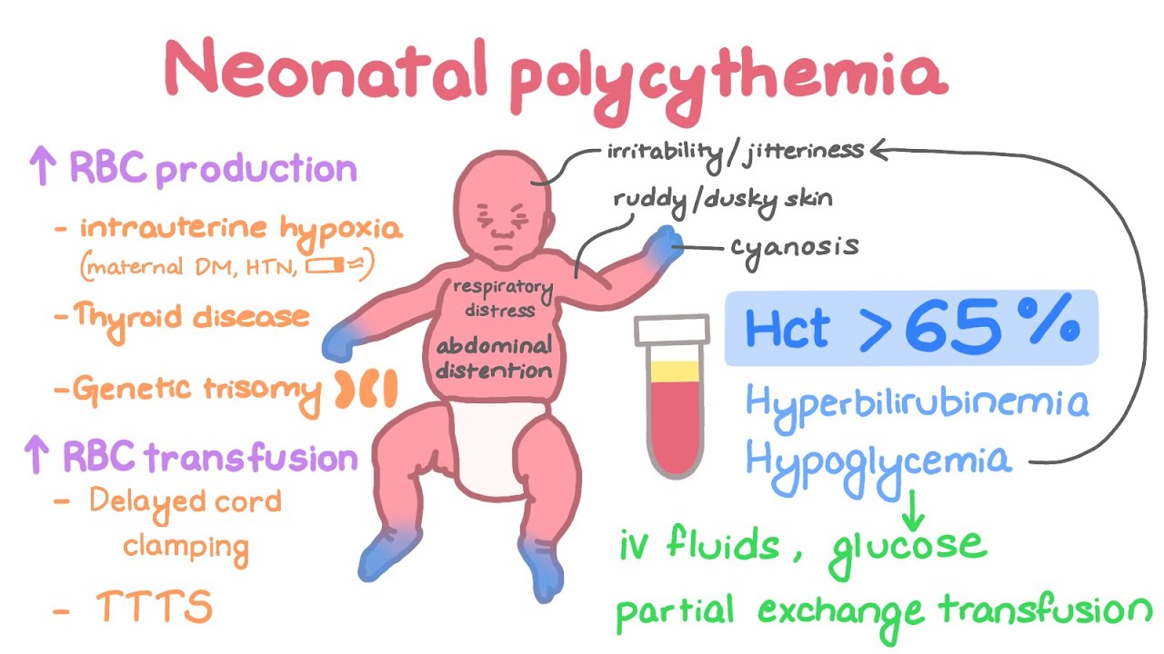 Neonatal Polycythemia - YouTube
