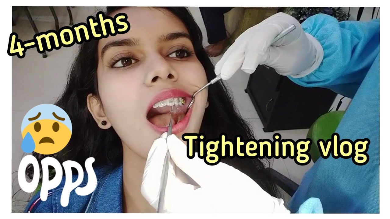 4-months braces update/first tightening vlog😁.... - YouTube