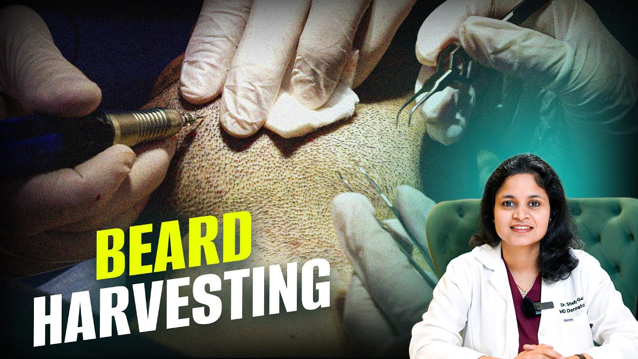 Beard to Scalp Hair Transplant: Who Needs It & How It Works? 🤔 | New ...