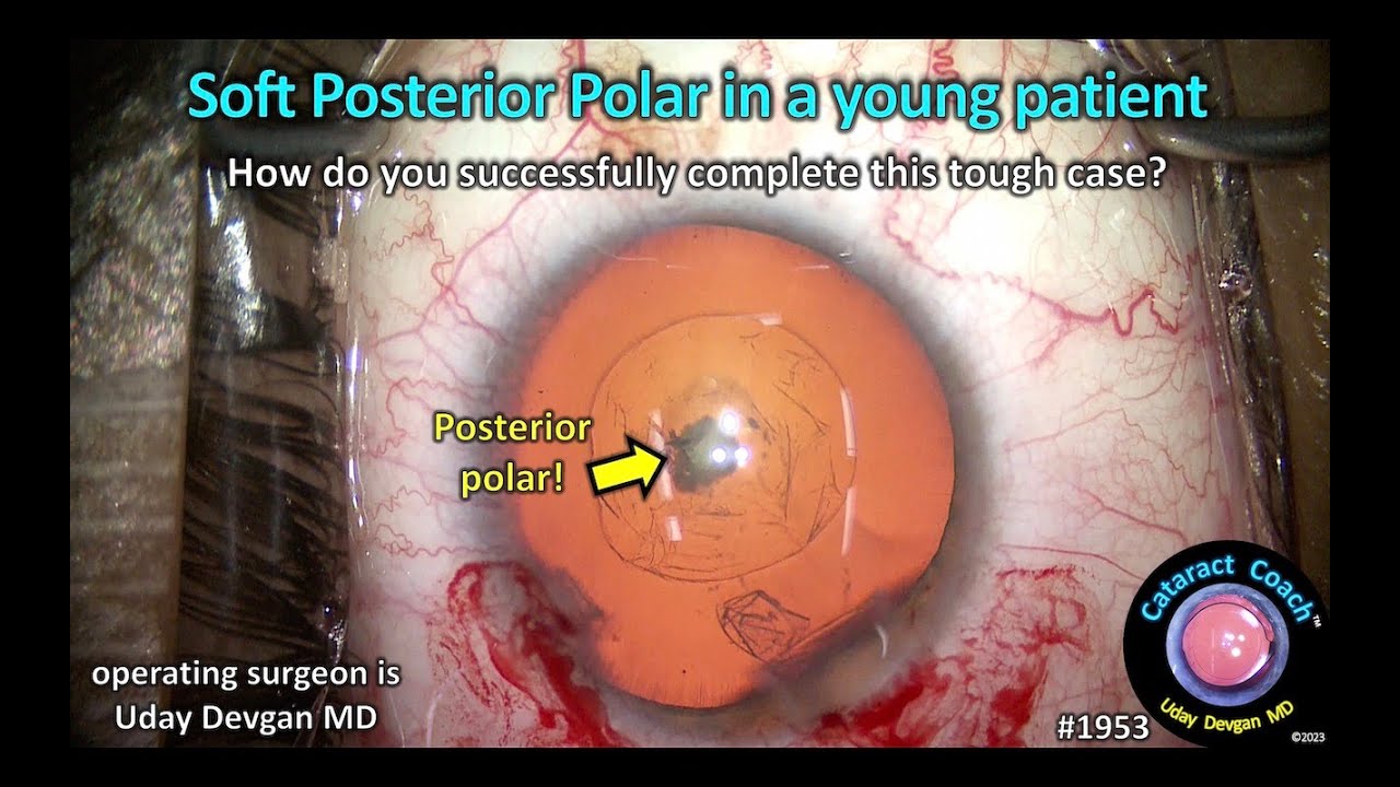 CataractCoach™ 1953: soft posterior polar cataract in a young patient ...