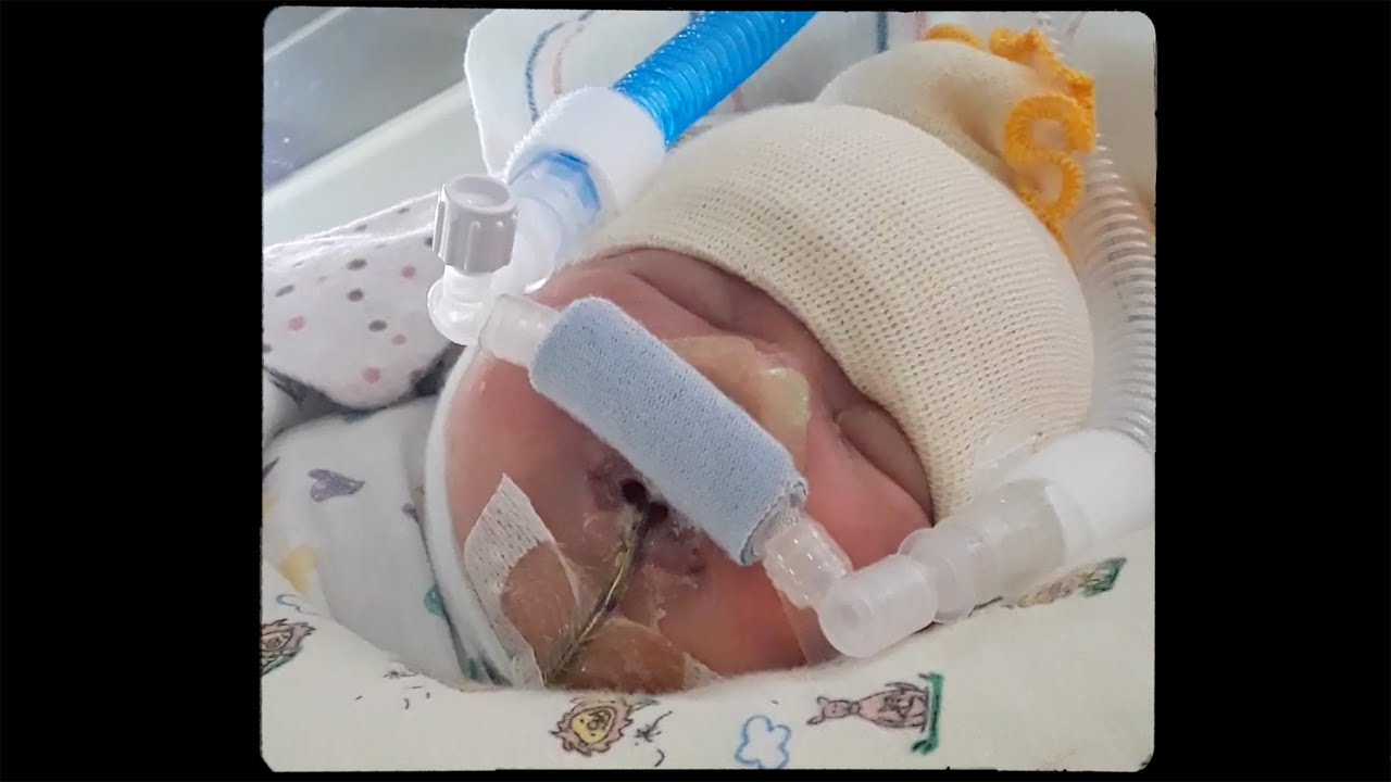 RAM Cannula With Cannulaide Versus Hudson Prongs For, 45% OFF