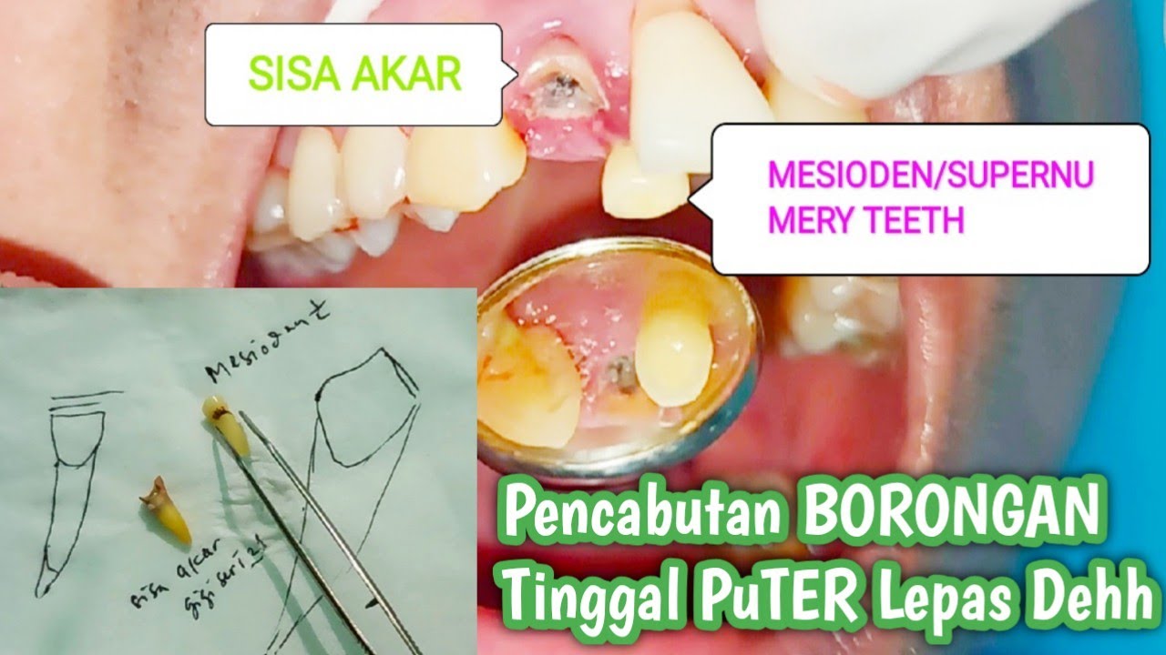 Pencabutan Borongan Gigi Mesioden/Supernumery dan Sisa Akar Gigi Depan Atas Tinggal Puterrrr ...