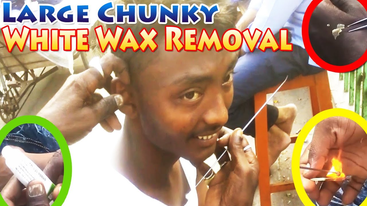 WOW! Great to Work with-Impacted Large Plug Wax Removed Nicely / Got ...