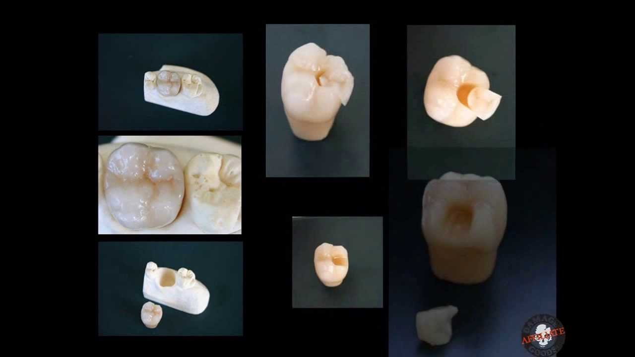 Onlay achieved with GC Gradia - YouTube