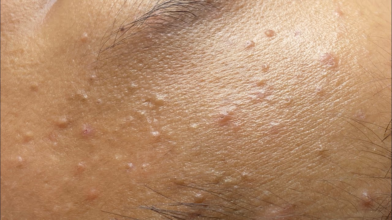 "Relaxing Deep Facial Cleaning | Gentle Skincare Session #523 P1 - YouTube