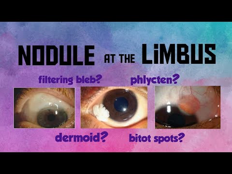 Nodule at the limbus / limbal nodule + EASY MNEMONIC inside ...