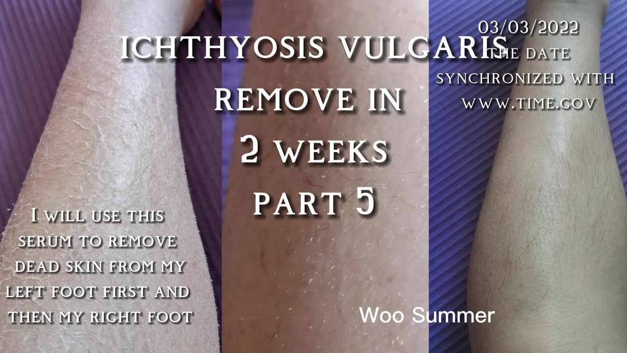 Best ichthyosis vulgaris treatment dry skin removed in 2 weeks part 5 ...