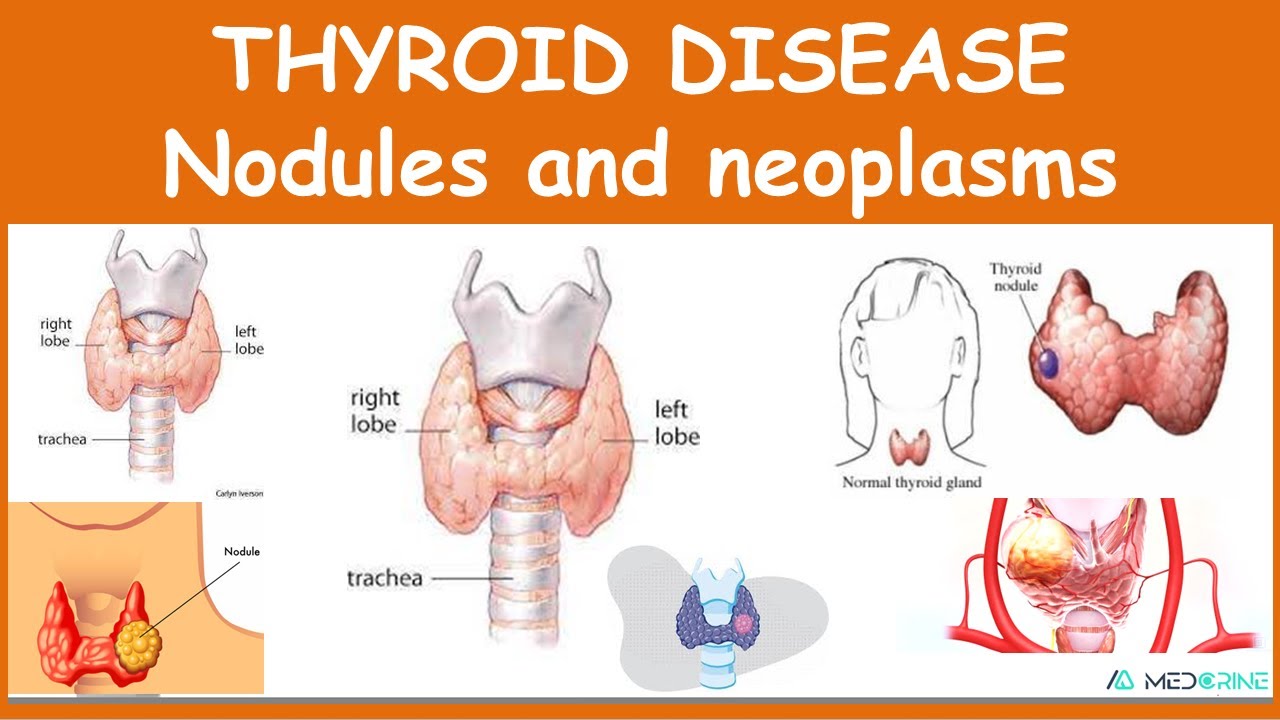 Thyroid Diseases: Nodules and Neoplasms - YouTube