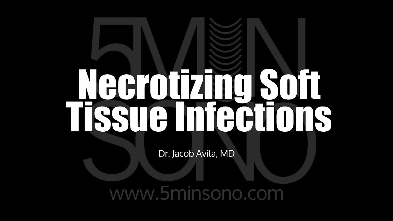 Necrotizing Soft Tissue Infection Youtube
