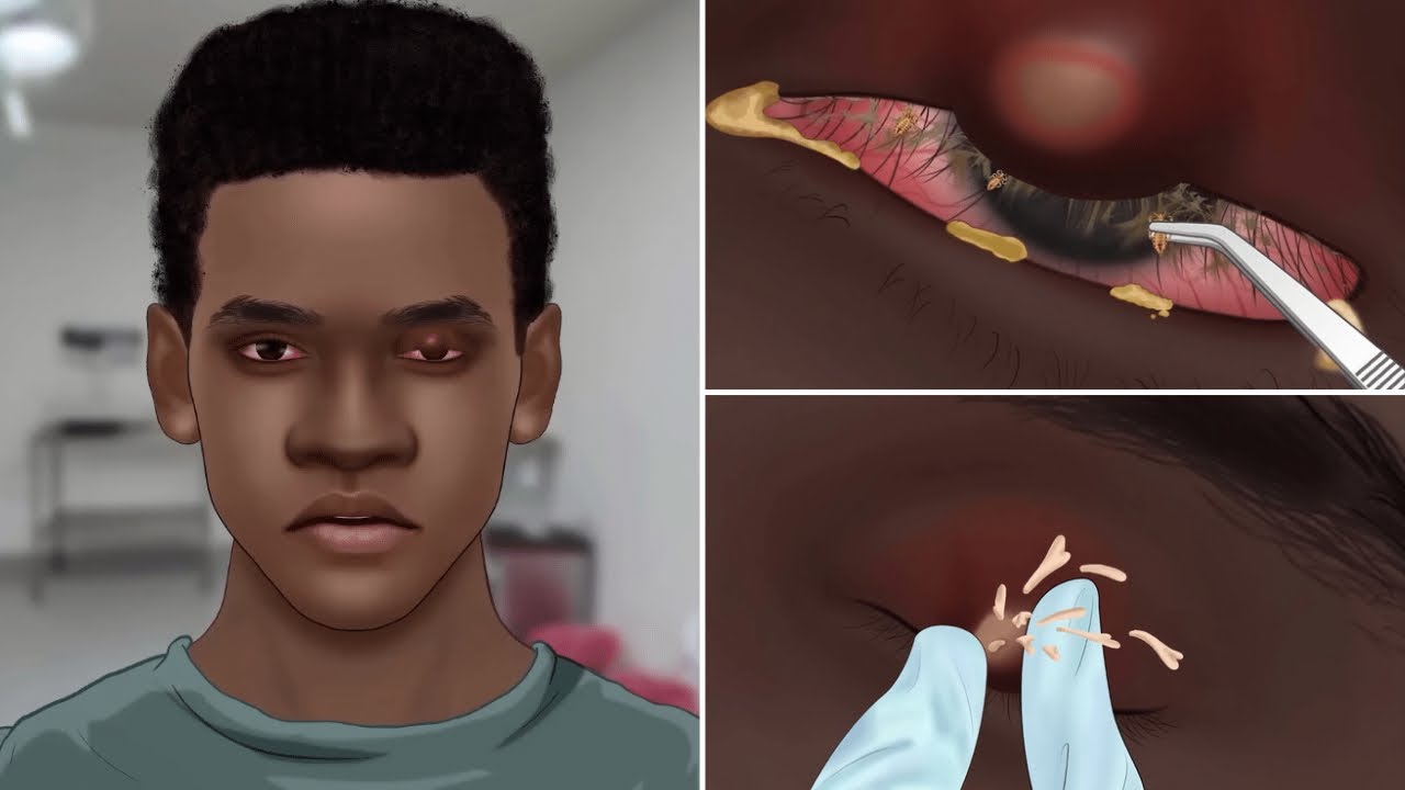 ASMR Eyelid Big Acne Extrusion Animation | Eye Discharge Removal | Deep ...