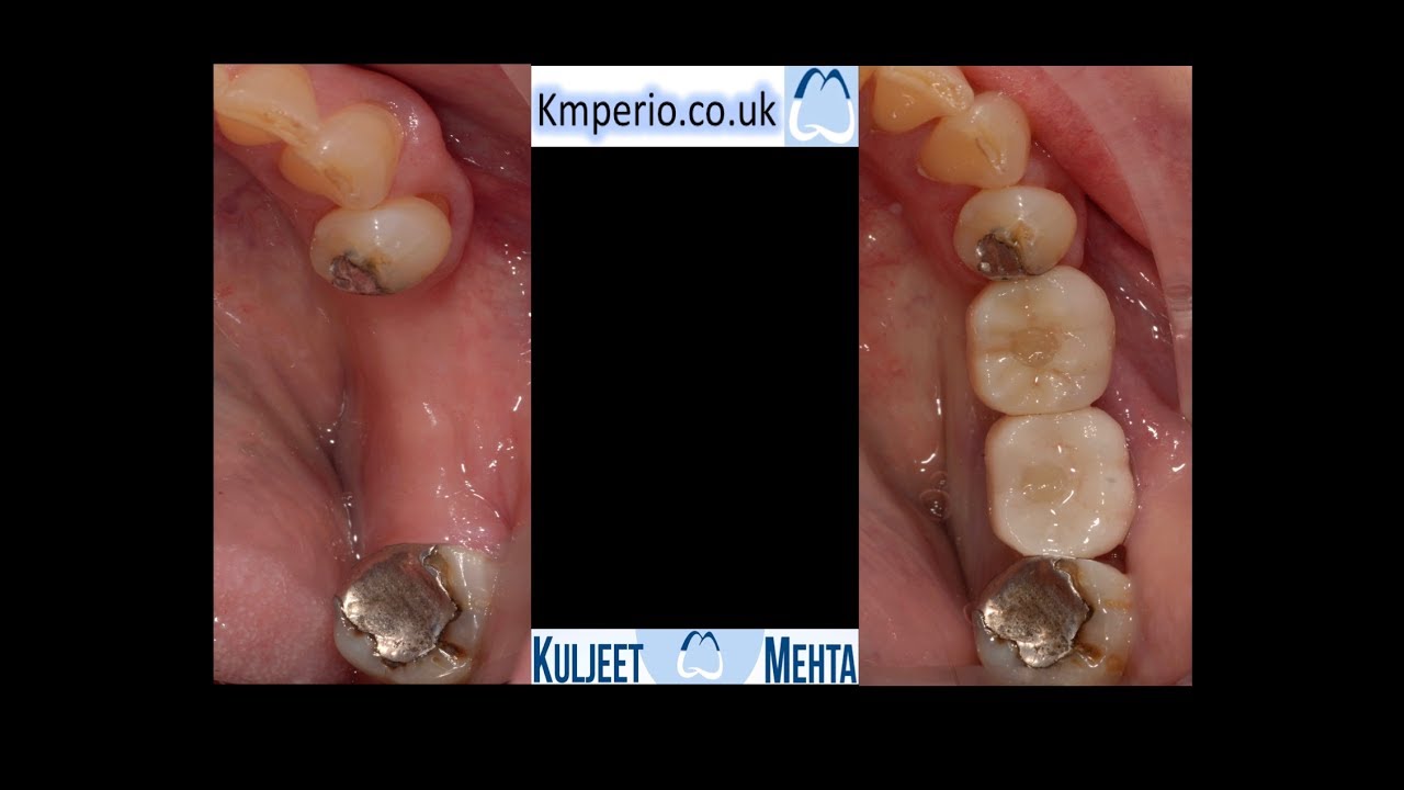 Flapless Dental Implant surgery with R2GATE - YouTube