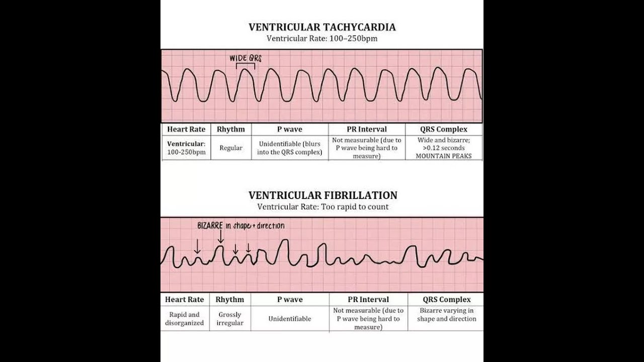 ventricular tachycardia ; Definition, Causes, Symptoms, Diagnosis ...