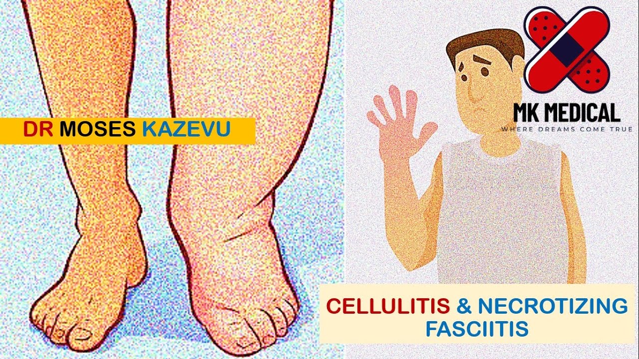 Cellulitis || Necrotizing Fasciitis - Diabetes Cellulitis || Necrotizing Fasciitis - Diabetes