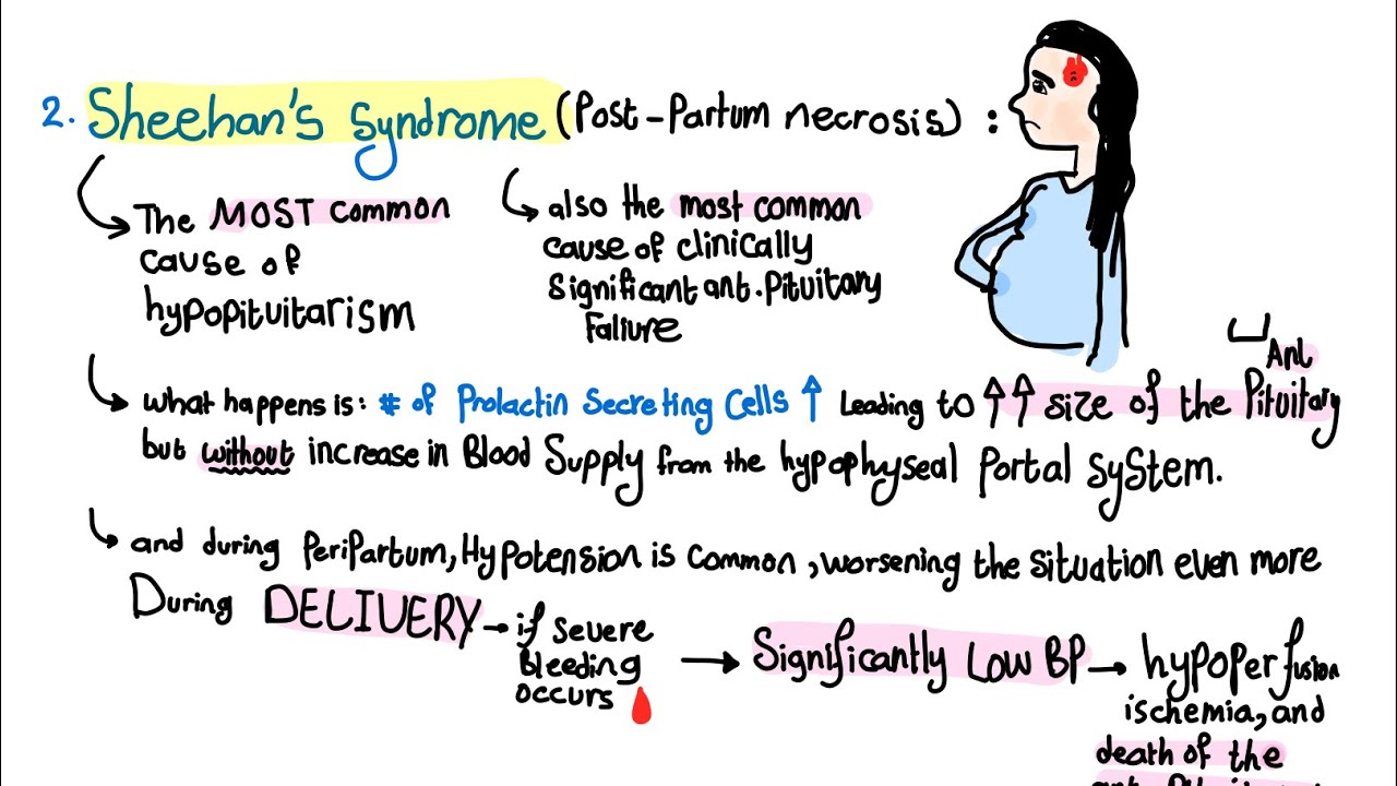 Sheehan's Syndrome in one minute ! - YouTube