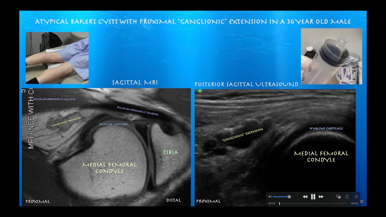 Ultrasound Guided Aspiration/Injection of "Ganglionic Extension" of an ...