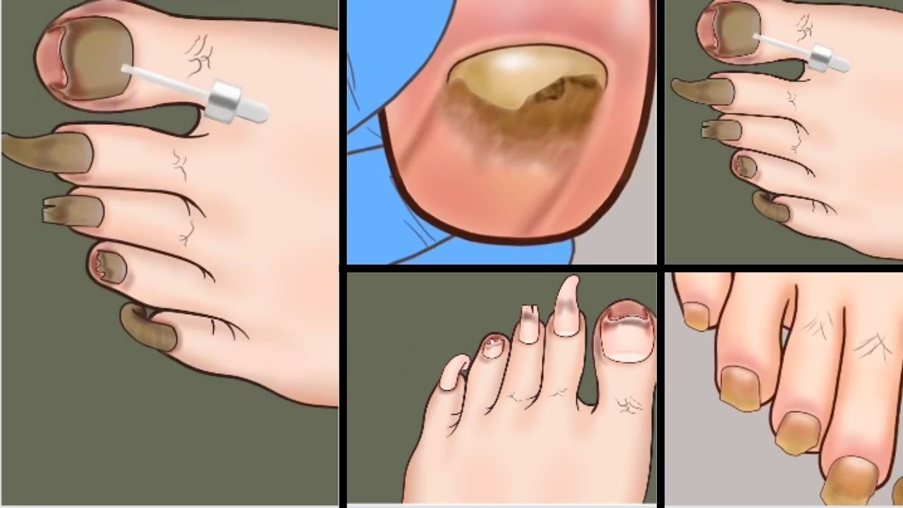 ASMR Athlete's Toenail Treatment Animation - YouTube