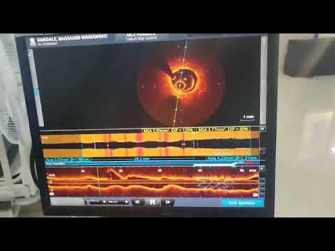 OCT GUIDED ISR ANGIOPLASTY(1) - YouTube