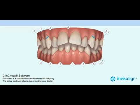 Invisalign ClinCheck at The Gill Clinic - YouTube