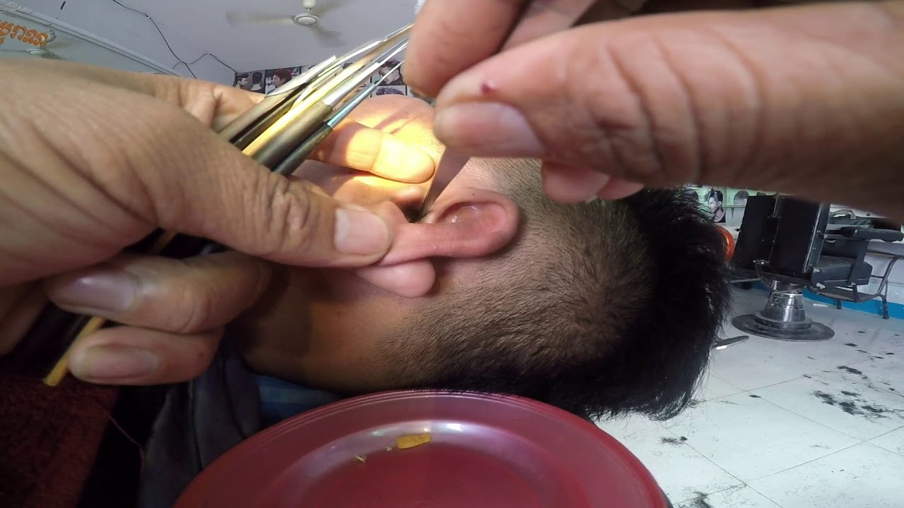 Earwax Removal Extraction ,Cleaning the fungus of the external auditory ...