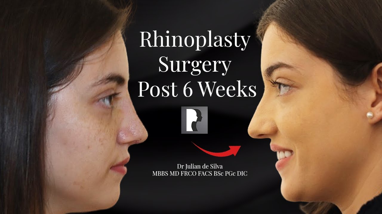 Before & After: 5 Months Post Rhinoplasty - Incredible Results & a ...