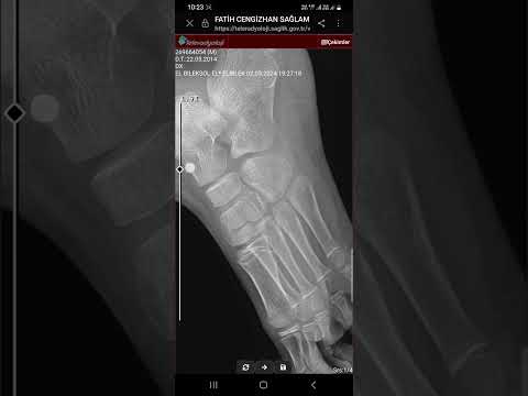 Hastane Röntgen Görüntüleme | Hastanede Çekilen Röntgeni Nasıl Görebilirim | Radyoloji Filmi Görme