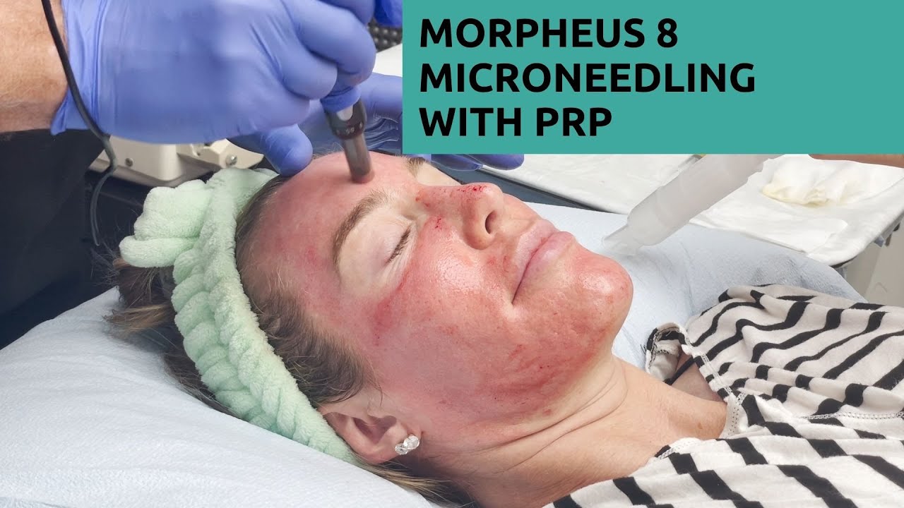 Morpheus 8 Microneedling with PRP | Dr. Frederick Coville, M.D. - YouTube