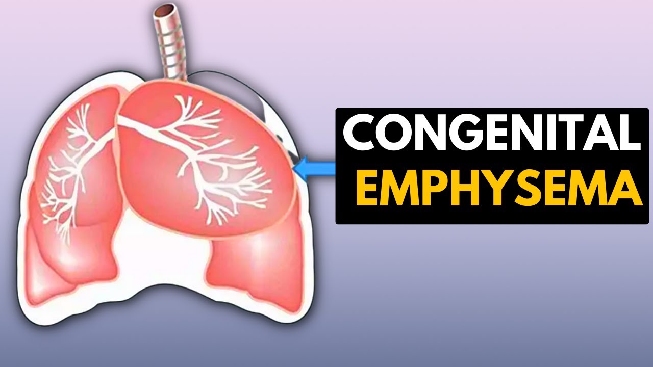 Beyond the Surface: Exploring Congenital Emphysema and Its Hidden Effects - YouTube