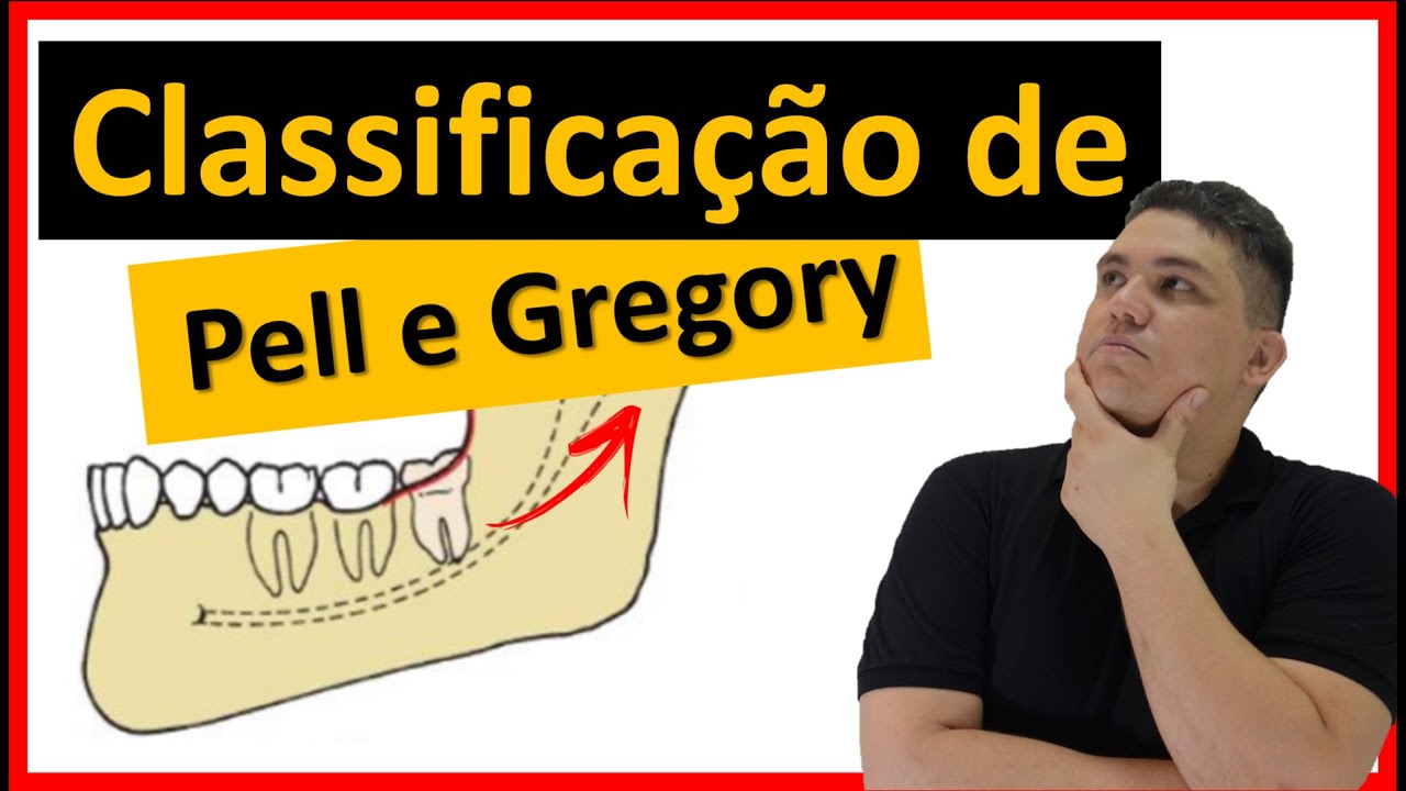 Classificação de Pell e Gregory - YouTube