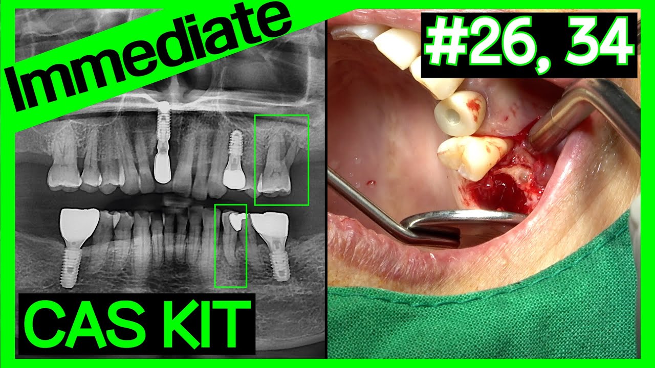 [Online Surgery] Maxillary immediate implant with CAS KIT & mandibular ...