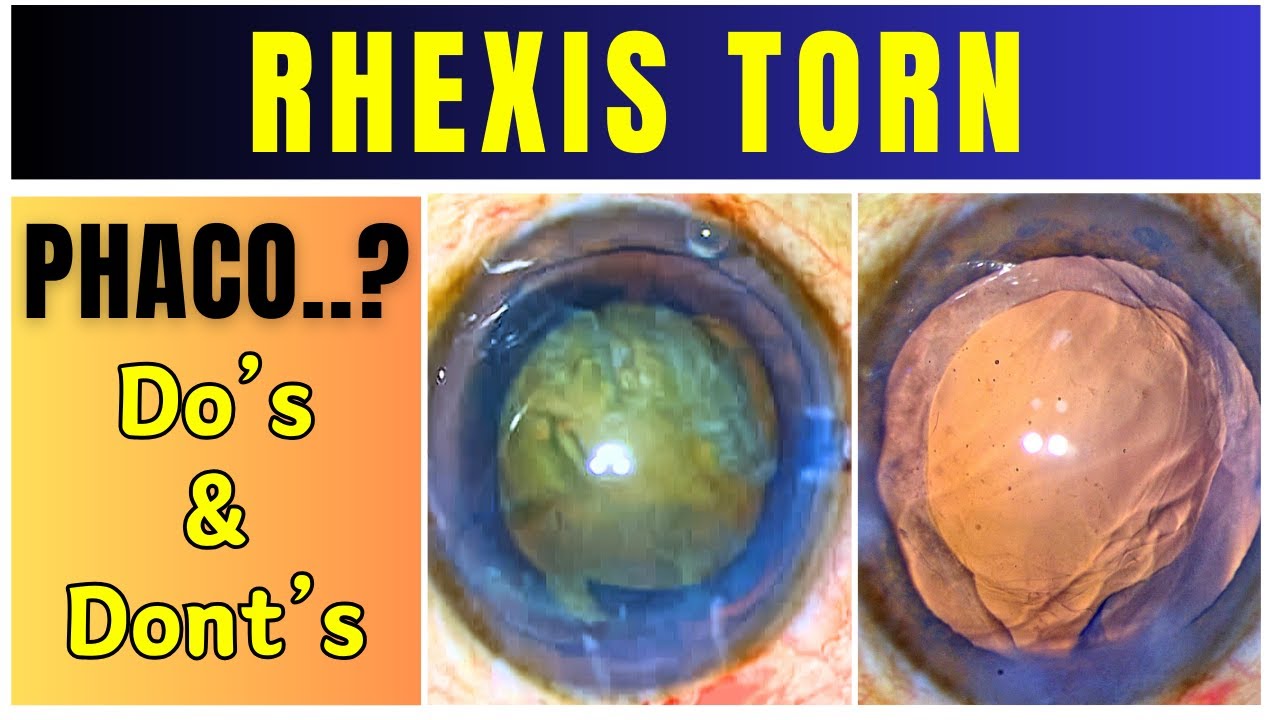 Rhexis is torn.! Dos and Don'ts for Phacoemulsification: Principles to ...