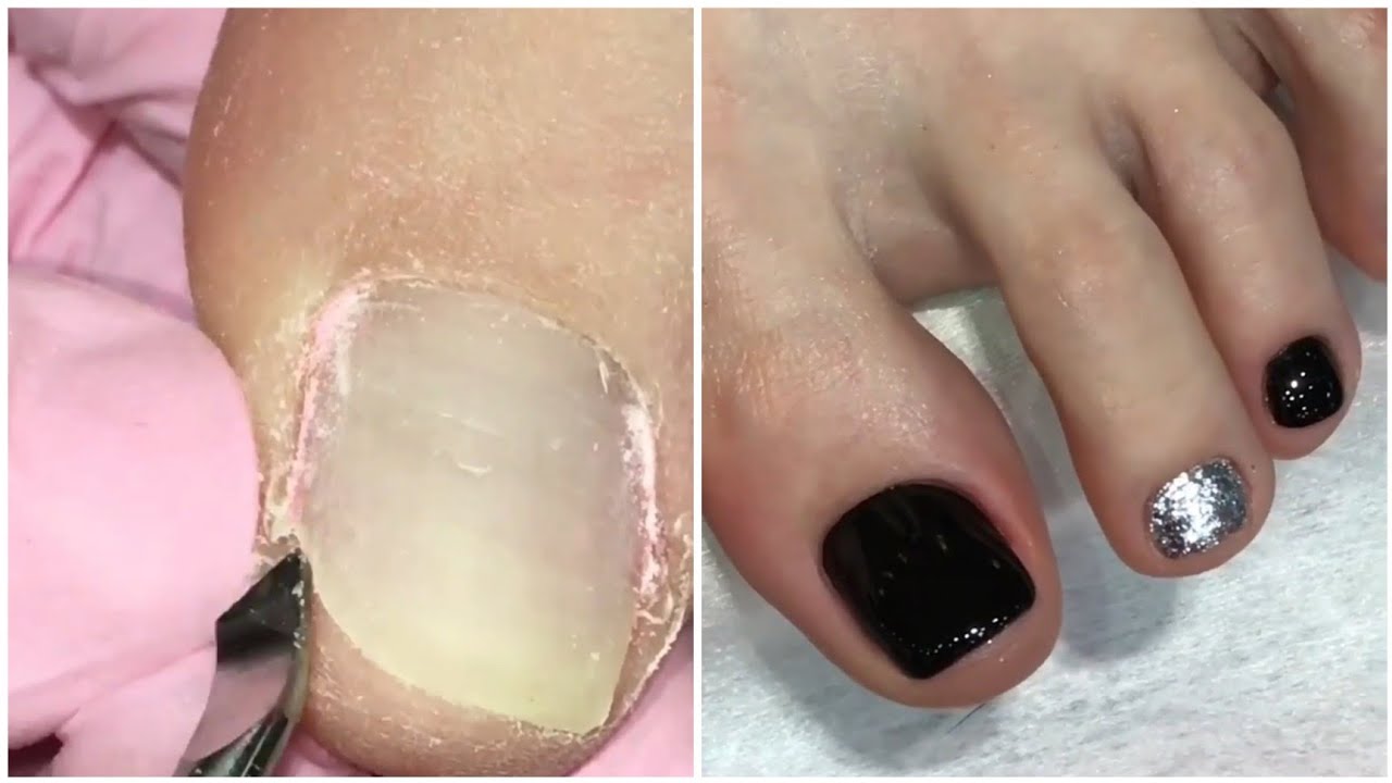 Most Satisfying Pedicure Transformation 😱 best nail polish for toes ...