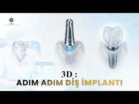 🤍 3D: Türkiye'deki Lema Kliniği'nde Adım Adım Diş İmplantı Tedavisi Planlaması!