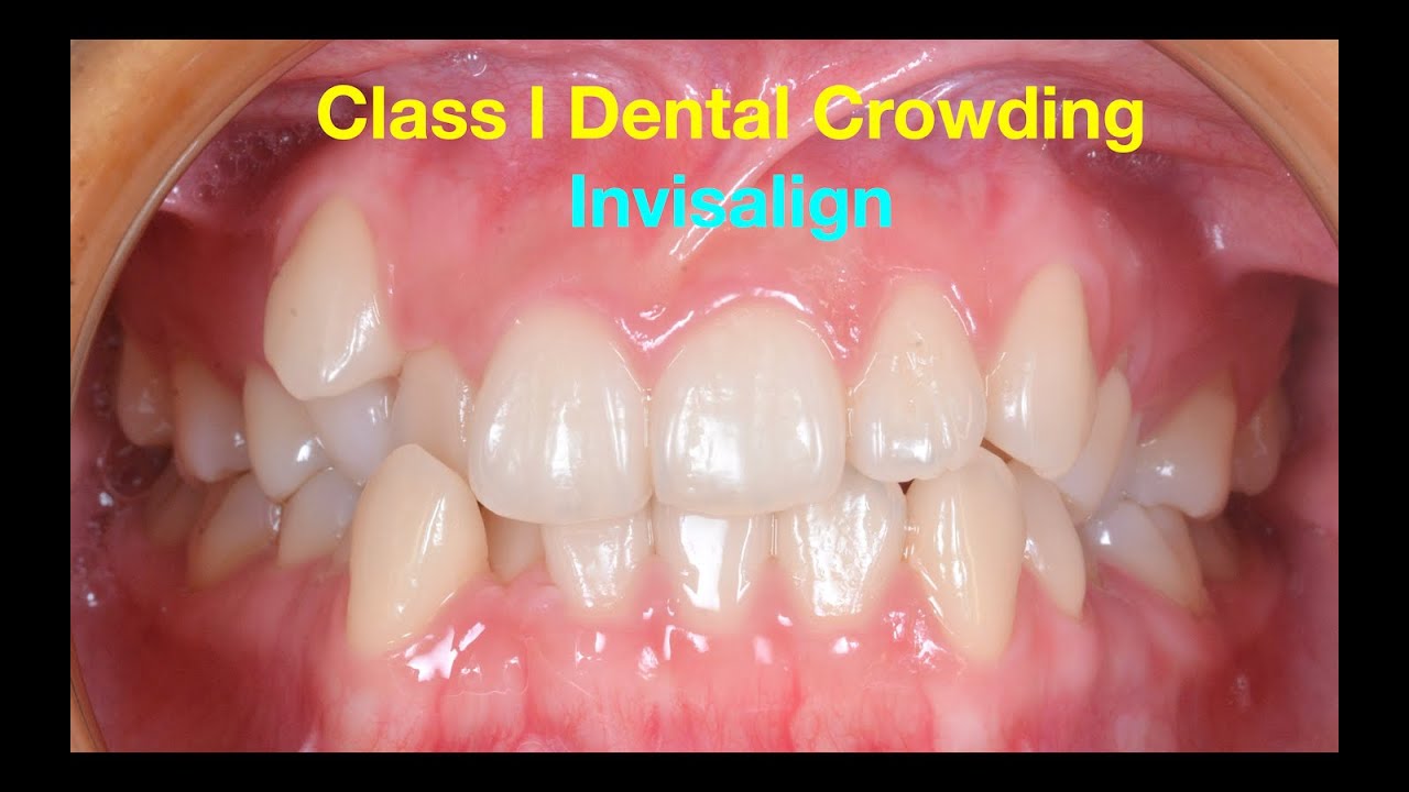 Treatment of Class I Dental Crowding with Invisalign｜【Chris Chang Ortho ...