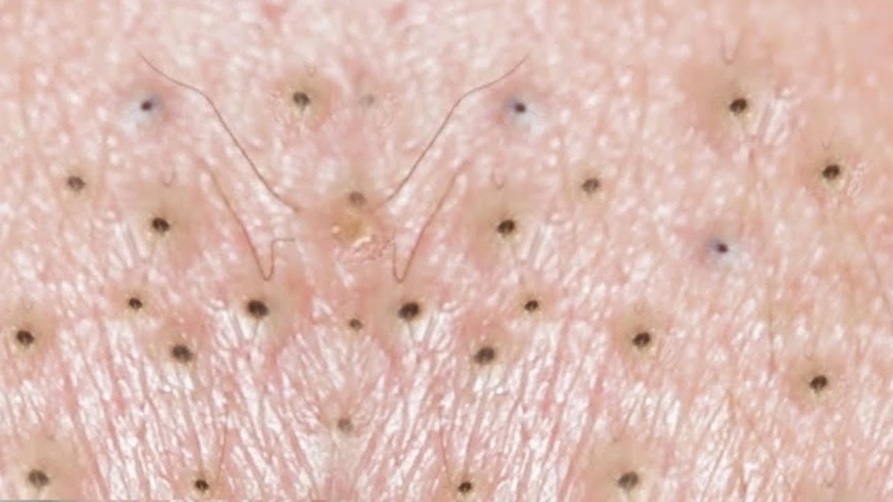 Satisfying Big Pimple Pop Up #15 | Nặn Mụn Đầu Đen Siêu To | Pimple ...