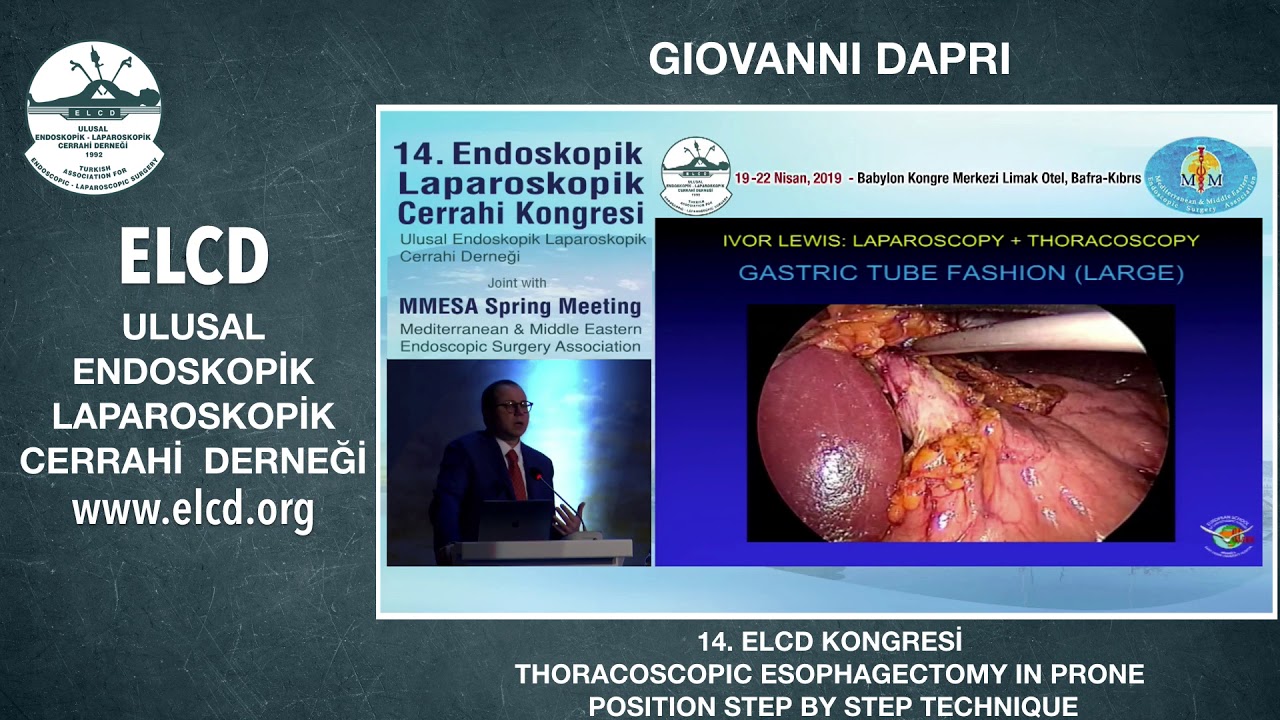 THORACOSCOPIC ESOPHAGECTOMY IN PRONE POSITION STEP BY STEP TECHNIQUE ...
