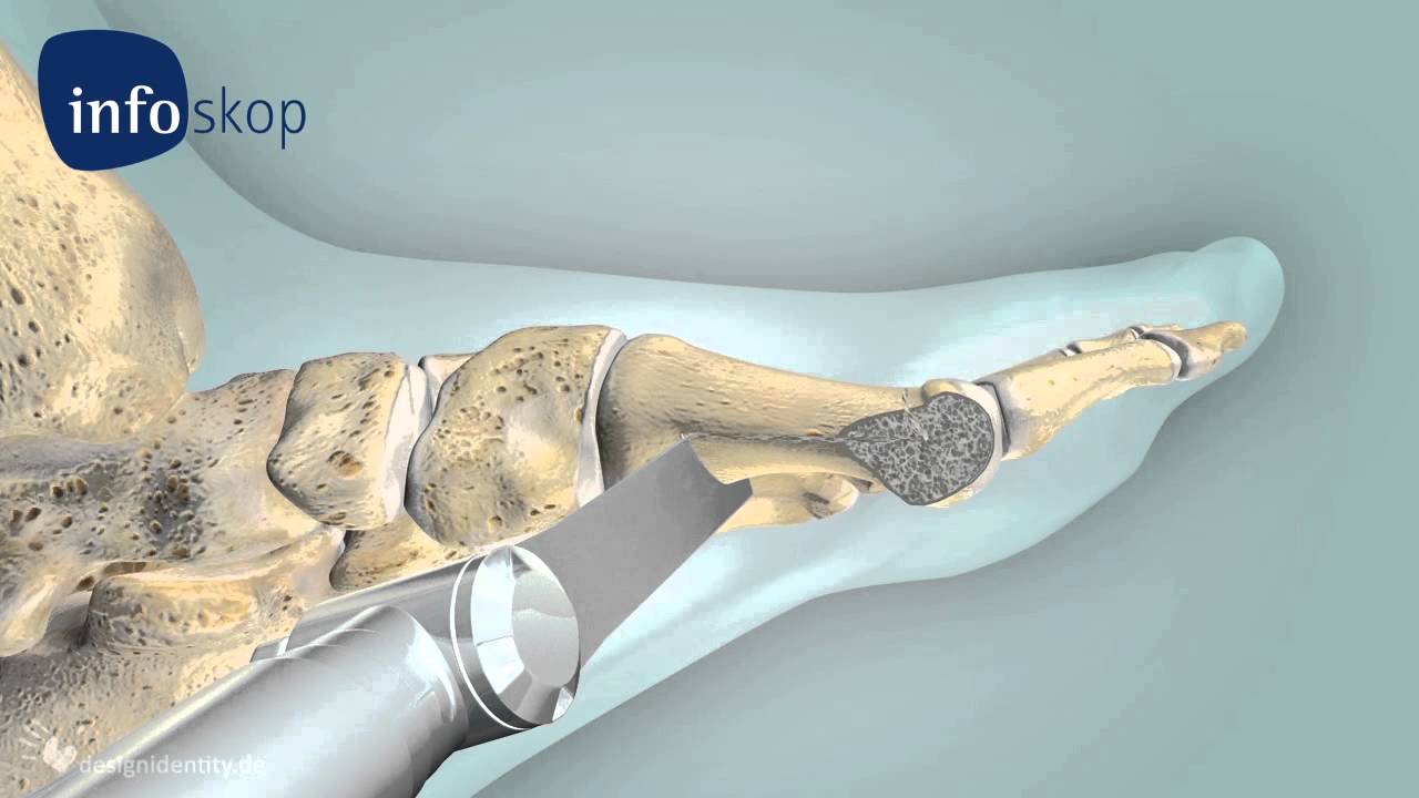 3D medical animation - Osteotomy - Hallux Valgus - designidentity - YouTube