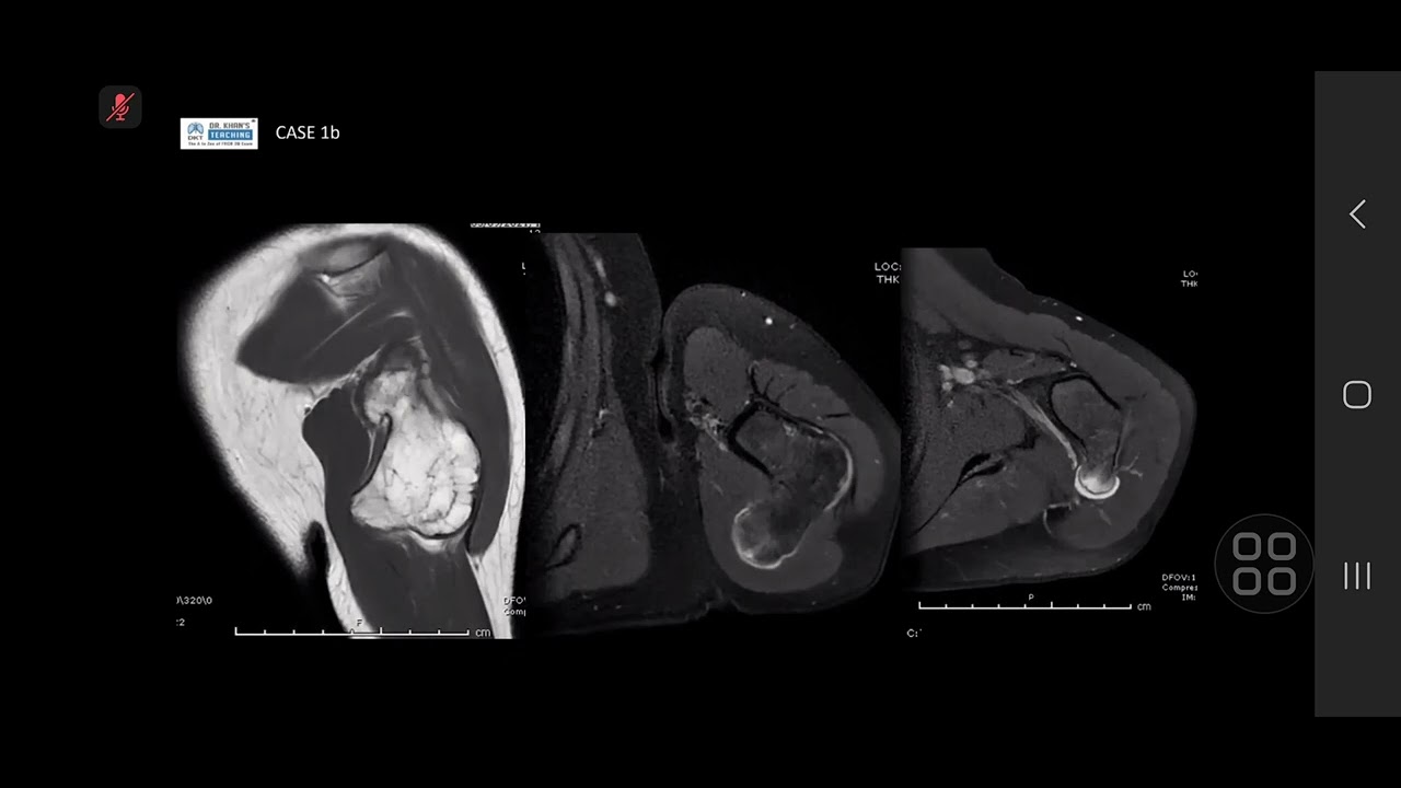 DKT MSK infection,tumor and dysplasias session 25/40 - YouTube