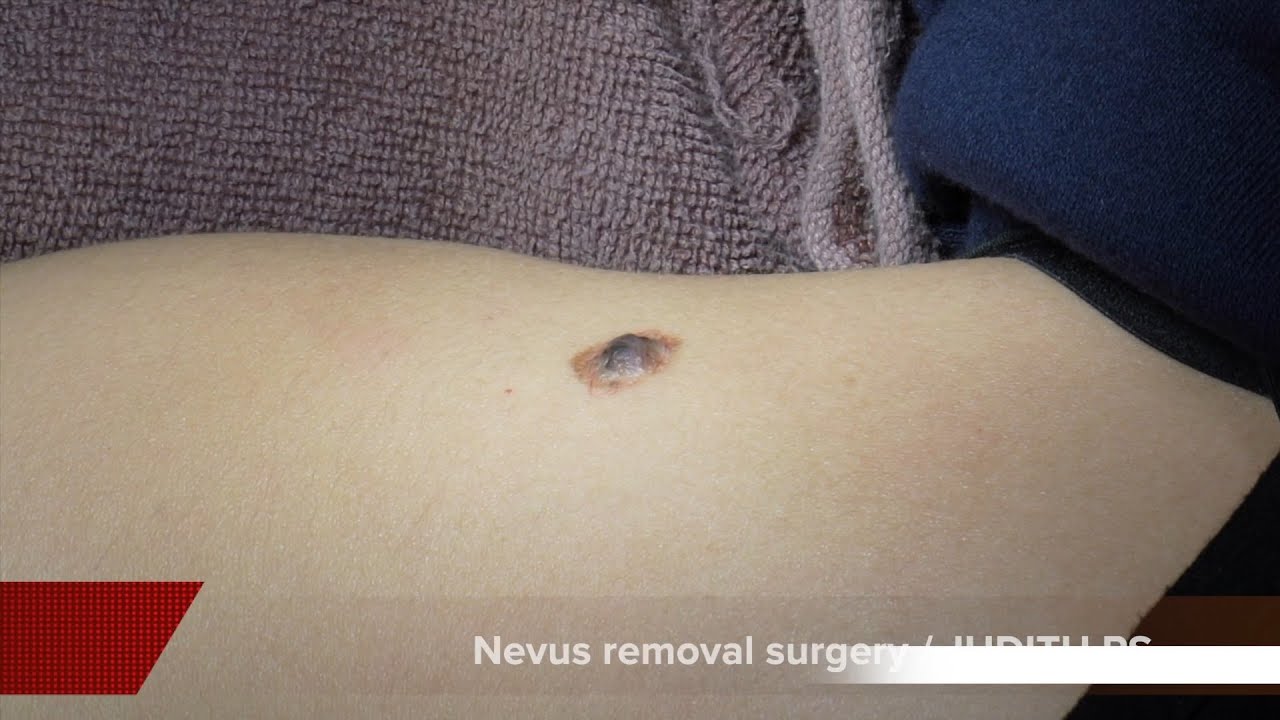 Nevus removal surgery 등 모반 제거 수술 - YouTube