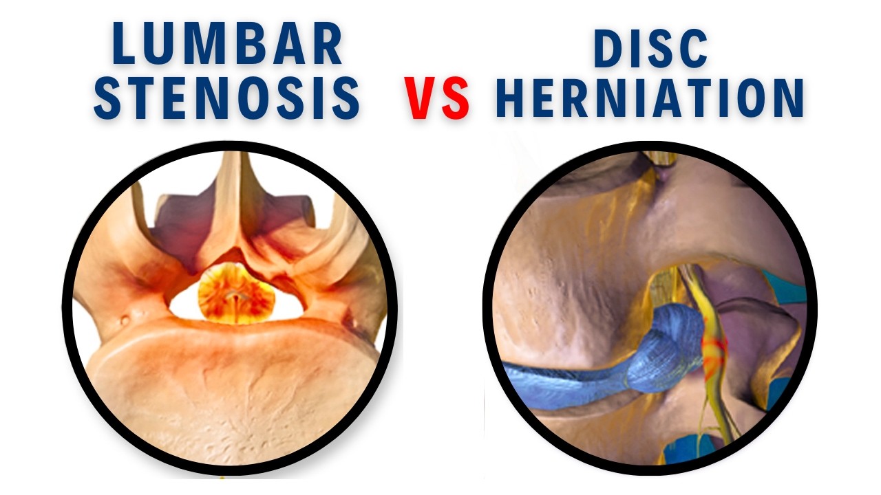 Lumbar Stenosis vs Herniated Disc: 5 Signs You Must Know Before Your ...