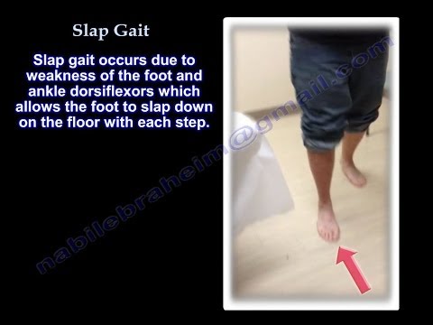Slap gait , Steppage Gait . Foot Drop - Everything You Need To Know - Dr. Nabil Ebraheim