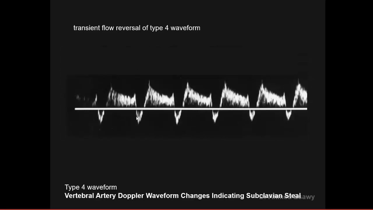 Reverse Flow Ultrasound Arterial Steal