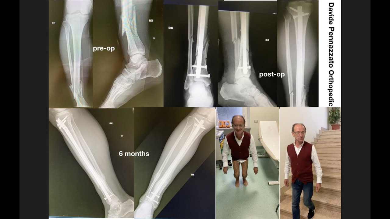 Intramedullary nail for a distal tibia-fibula multifragmentary fracture ...